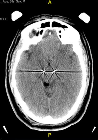 Morphometric Analysis Of Subthalamic Nuclei In Patients Of Deep Brain Stimulation In Parkinsons