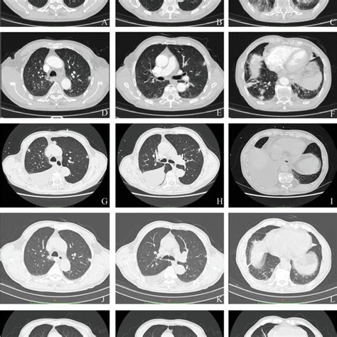 Serial Chest Computed Tomography Ct Scans Of The Patient With