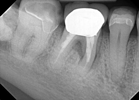 Rct Vs Extraction Cases And Questions Osseonews