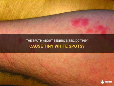 The Truth About Bedbug Bites Do They Cause Tiny White Spots Medshun