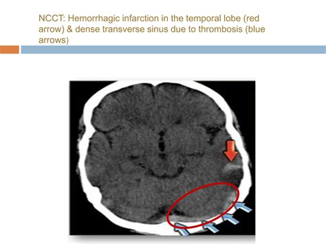 Cortical Cerebral Venous Thrombosis Cvt Management Dr Ganeshpptx