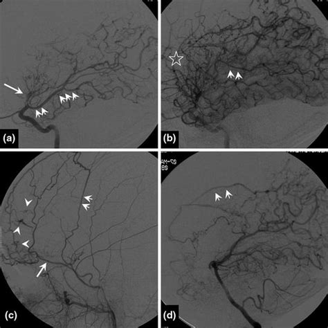 Rare Cerebral Angiopathies Neupsy Key
