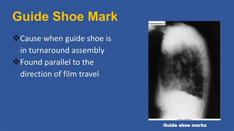 Artifacts In General Radiography For Radiodeptpptx