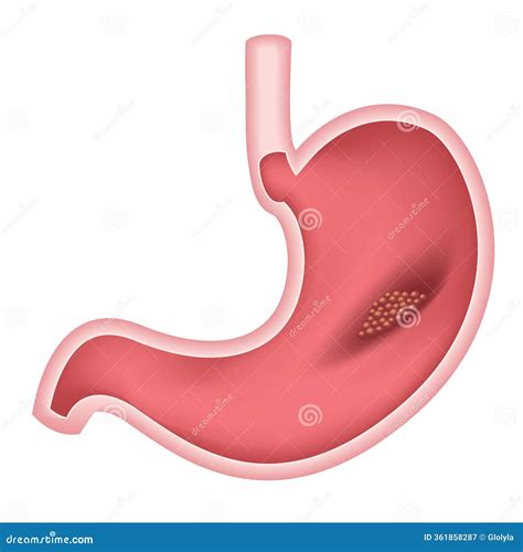 Gastric Cancer Stomach Tumor In The Digestive System Cartoon Vector