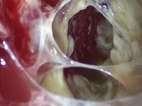 7 Pleural Infection Thoracic Key