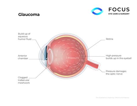 Glaucoma Treatment In Queens Nyc Long Island