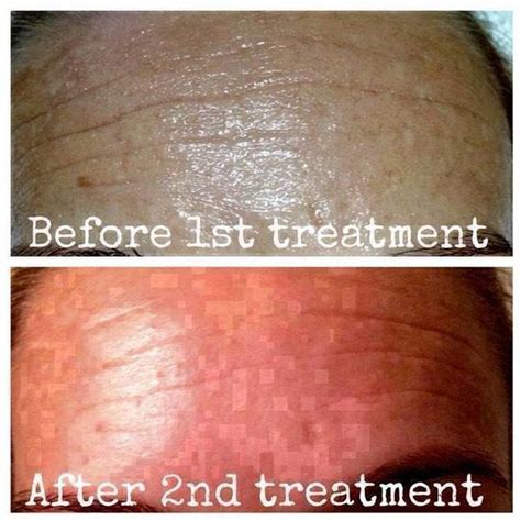 Microcurrent Face Lift Before And After 2nd Treatment Facelift Info Prices Photos Reviews Qanda