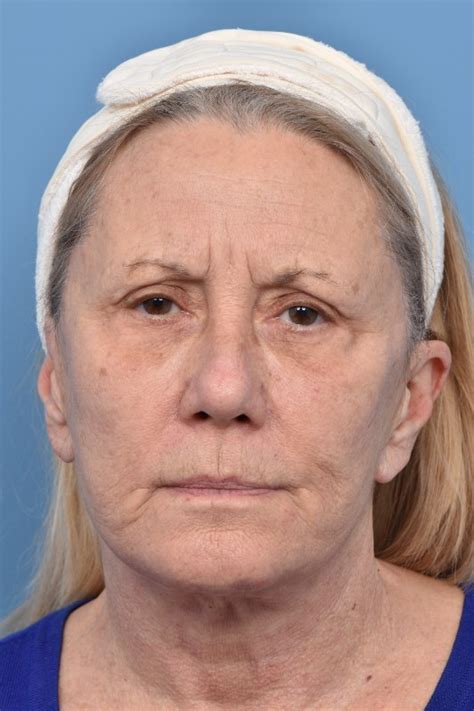 Brow Lift Before And After 42 Contoura