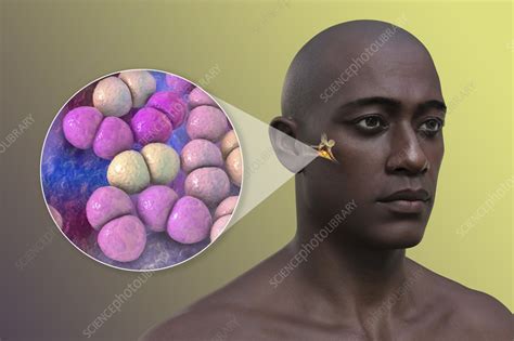 Middle Ear Infection 3d Illustration Stock Image F0424985
