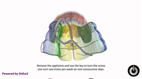 Upper Removable Expander Schwartz Appliance Youtube