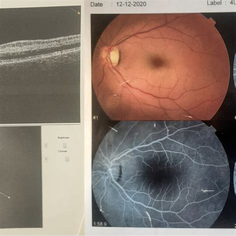 Pdf Early Onset Monocular Hydroxychloroquine Maculopathy In A Systemic Lupus Erythematosus