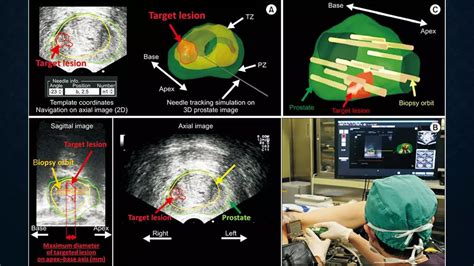 Prostate Biopsypptx