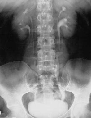 Duplicated Collecting Systems Duplex Kidney Duplicated Ureters