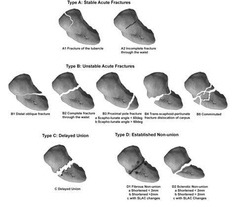 Scaphoid Fracture Zones At Tamara Wilson Blog