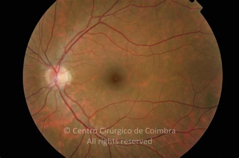 Caso Clínico 2 Atlas Rl Eye