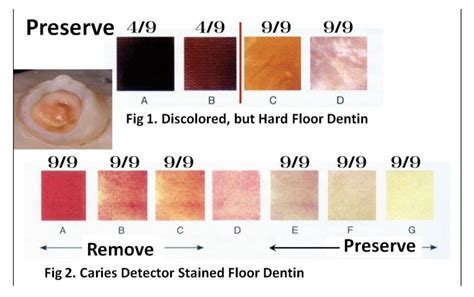 What Should Be Removed When Doing The Caries Removal