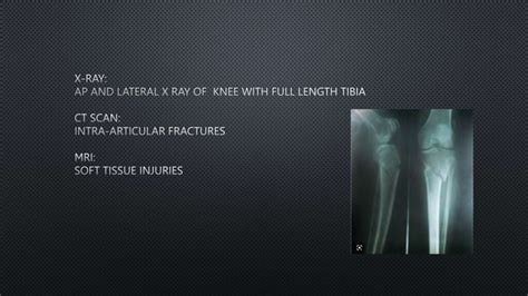 Fractures Around Knee Pptx