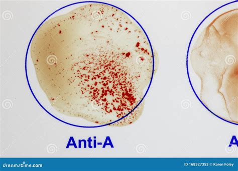 Antibody A Blood Agent Test Stock Image Image Of Typing Result