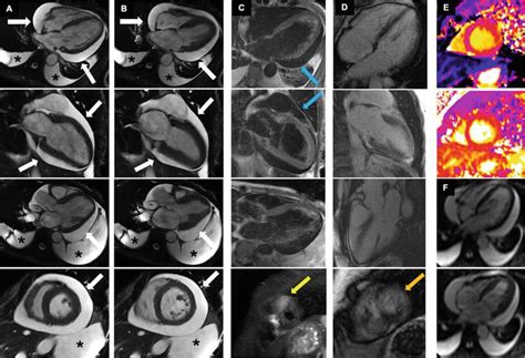 Cardiac Magnetic Resonance In Progressive Systemic Sclerosis