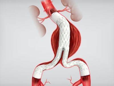 Endovascular Abdominal Aortic Aneurysm Repair Evar