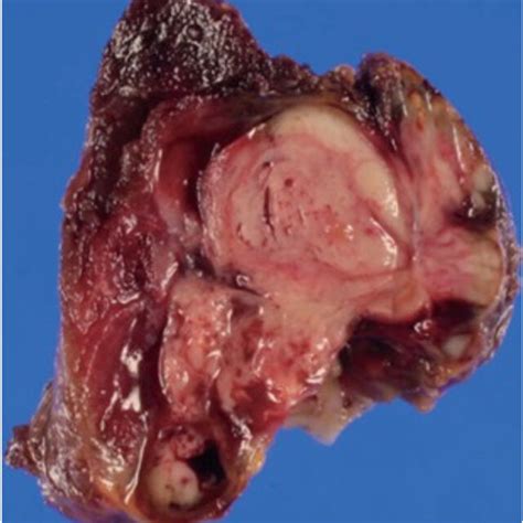 Gross Appearance Of Parathyroid Carcinoma This Surgical Specimen Shows Download Scientific