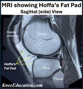 Hoffas Fat Pad Impingement Knee Education