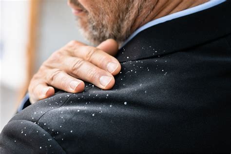 Get The Best Treatment To Deal With Dry Scalp Problems