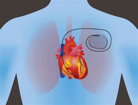 Icd Pacemaker Placement Implantable Cardioverter Defibrillator Icd