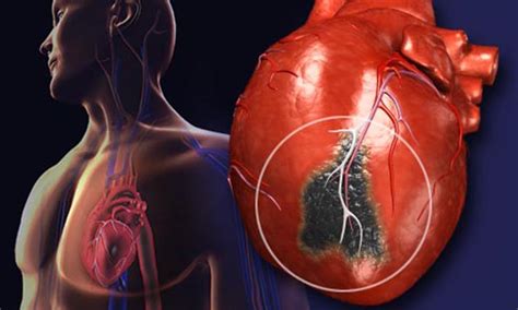 Arditor 5 Steps To Protect Your Diabetic Heart