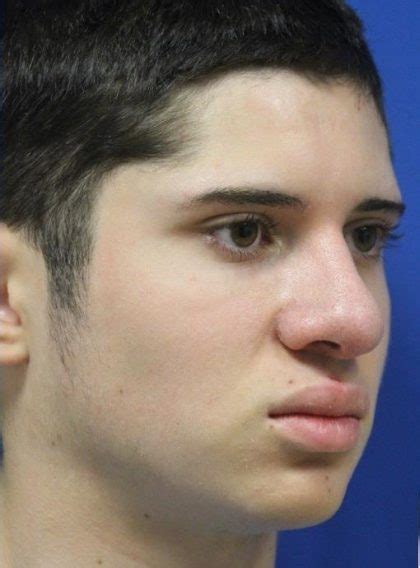 Patient 13596 Septoplasty Before And After Photos New York Ny