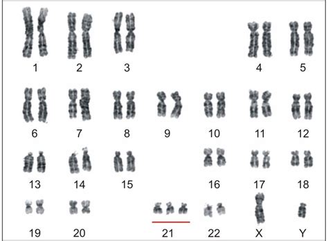Chromosomenanalyse Karyogramm Cenata Gmbh