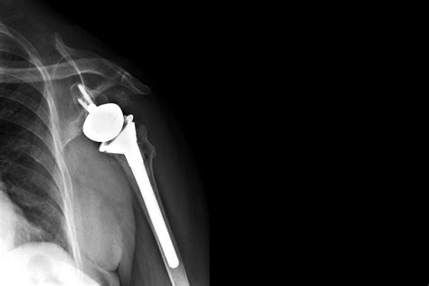Protesi Spalla Indicazioni Tipologie Preparazione E Convalescenza