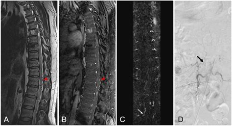A 42 Year Old Patient With Spinal Dural Arteriovenous Fistula SDAVF