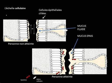La mucoviscidose 1 exemple de maladie génétique Site des Sciences
