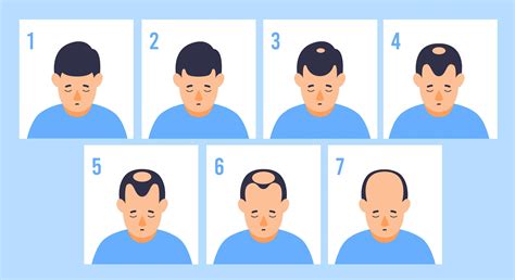 Male Pattern Baldness 7 Different Stages Of Hair Loss In Men Formen
