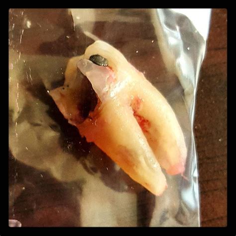 Decayed Molar Rteethporn