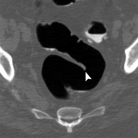 Primary 2d Versus Primary 3d Polyp Detection At Screening Ct