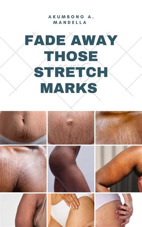 Fade Away Those Stretch Marks Ebook Akumbong A Mandella