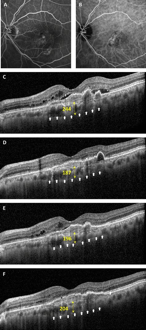 A Representative Case Of A 69 Year Old Male With Polypoidal Choroidal Download Scientific