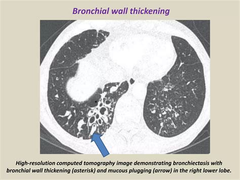 Presentation1 Pptx Radiological Imaging Of Bronchiectasis Pptx