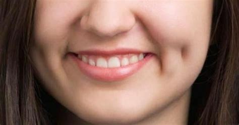 الغمازات Refresh Clinic