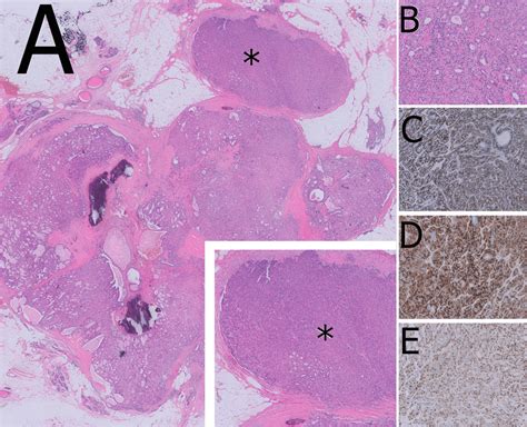 Adenomyoepithelioma With Partial Papillary Growth Pattern Showing Download Scientific Diagram
