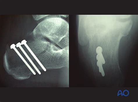 Orif Screw Fixation For Extreme Tongue Type Beak Fracture Of The Calcaneus Body
