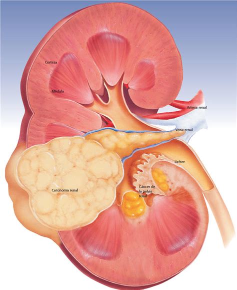 Askep Tumor Renal Askep Tumor Renal