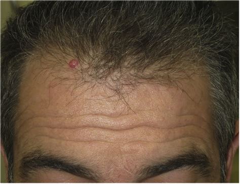 A Shiny Nodule On The Forehead Of A Man Actas Dermo Sifiliográficas