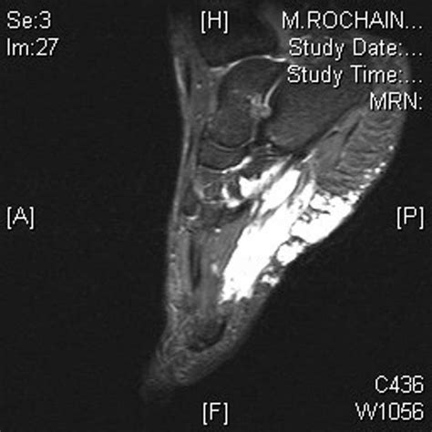 Hemangioma The Foot And Ankle Online Journal