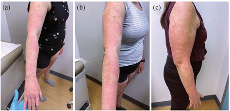 A Pink Confluent Scaly Plaques On The Upper Extremities With Islands Download Scientific