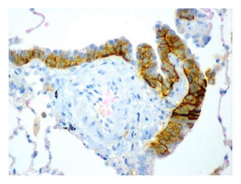 Case 2 A Carcinoid Tumor B Carcinoid With Strong And Diffuse Download Scientific Diagram