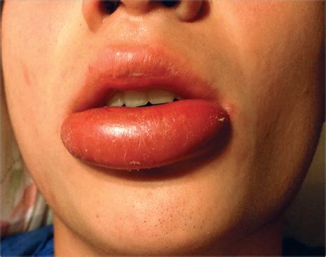 Lip Infection Medical Term At Julian Romilly Blog