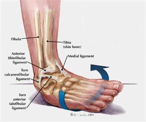 Blessures Aux Ligaments De La Cheville Turkey Istanbul Medical